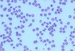 Haemolytic uraemic syndrome - Symptoms, diagnosis and treatment | BMJ ...