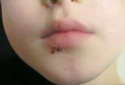 Impetigo - Symptoms, diagnosis and treatment | BMJ Best Practice US