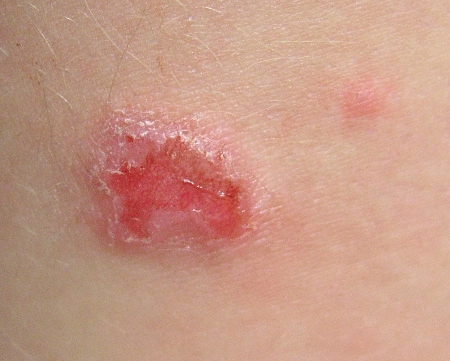 Impetigo On Hands