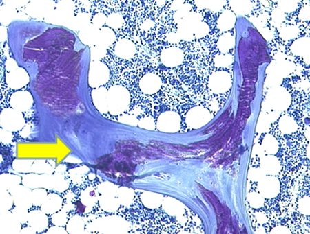 Osteomalacia - Symptoms, diagnosis and treatment | BMJ Best Practice