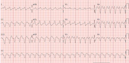 Sustained ventricular tachycardias - Symptoms, diagnosis and treatment ...