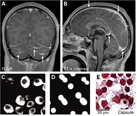 Fungal meningitis - Symptoms, diagnosis and treatment | BMJ Best Practice