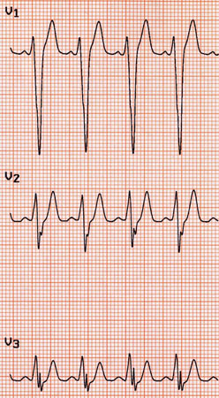 Assessment of palpitations - Differential diagnosis of symptoms | BMJ ...
