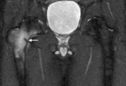 Dolor de ingle - Síntomas, diagnóstico y tratamiento | BMJ Best Practice