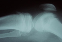 Doença de Osgood-Schlatter - Sintomas, diagnóstico e tratamento | BMJ ...