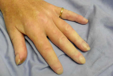 Limited cutaneous systemic sclerosis - Symptoms, diagnosis and ...