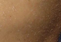Miliaria - Symptoms, diagnosis and treatment | BMJ Best Practice