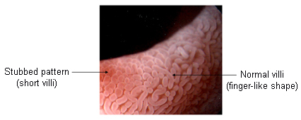 Tropical sprue - Symptoms, diagnosis and treatment | BMJ Best Practice