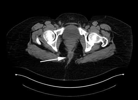 Abscesso anorretal - Sintomas, diagnóstico e tratamento | BMJ Best Practice