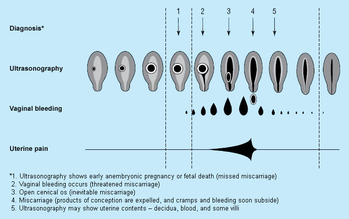 Beginning Stages Of A Miscarriage