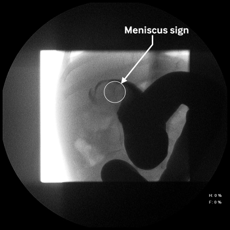 Meniscus Sign Intussusception