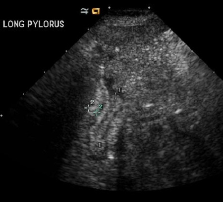 Pyloric stenosis - Symptoms, diagnosis and treatment | BMJ Best Practice