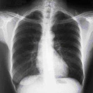 Assessment of chronic cough - Differential diagnosis of symptoms | BMJ ...