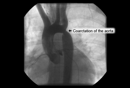 Aortic coarctation - Symptoms, diagnosis and treatment | BMJ Best Practice
