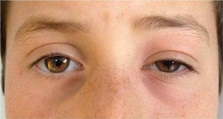 Celulite orbitária e periorbitária - Symptoms, diagnosis and treatment ...
