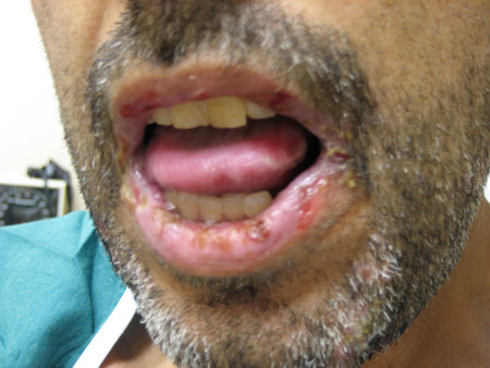 Assessment of vesicular-bullous rash - Differential diagnosis of ...