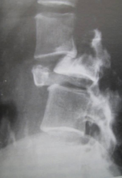 Osteoporotic spinal compression fractures - Symptoms, diagnosis and ...