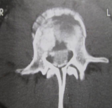 Fraturas osteoporóticas por compressão vertebral - Symptoms, diagnosis ...