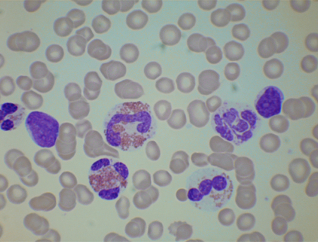 Eosinophils Blood Test Procedure Causes Of Eosinophilia