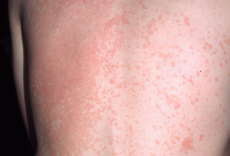 Pitiriasis Versicolor