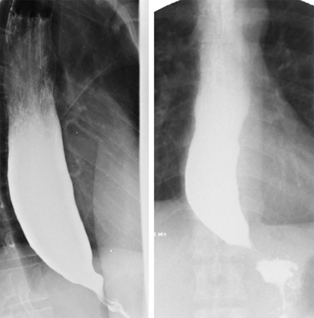 Acalasia - Sintomas, diagnóstico e tratamento | BMJ Best Practice