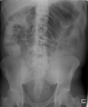 Toxic colitis and toxic megacolon - Symptoms, diagnosis and treatment ...