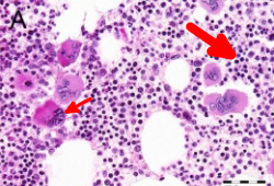 Essential thrombocytosis - Symptoms, diagnosis and treatment | BMJ Best ...