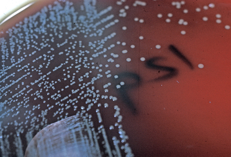 Brucellosis - Symptoms, diagnosis and treatment | BMJ Best Practice