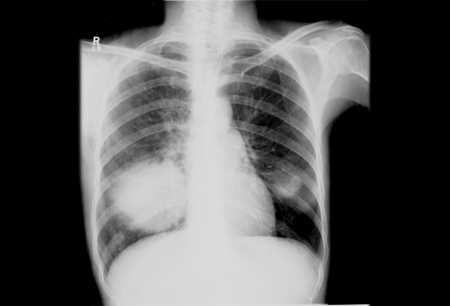 Cryptococcosis - Symptoms, diagnosis and treatment | BMJ Best Practice