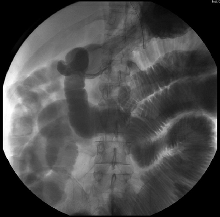 Vesalius Clinical Folios Terminal Ileitis